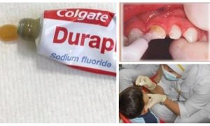 Sapuan Florida Sejak Awal Akan Kuatkan Gigi & Elak Karies. 7 Perkara ...
