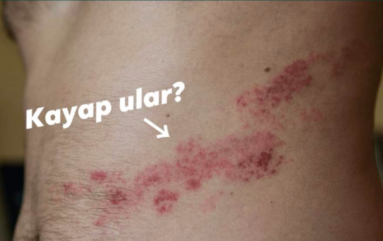 “Boleh Bawa Maut Jika Imuniti Badan Rendah”- Doktor Jelas Tentang ...
