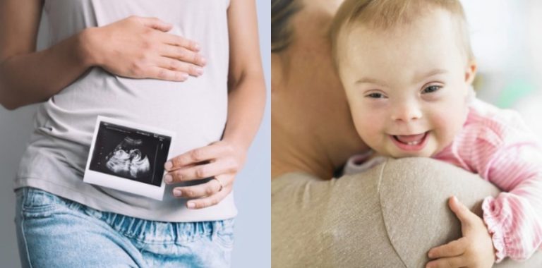 Tanda Mengandung Anak Sindrom Down Ibu Kena Perhatikan