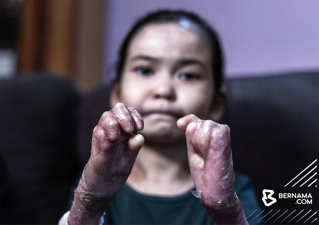 Penyakit Kulit Jarang Jumpa Dialami Dua Adik Beradik