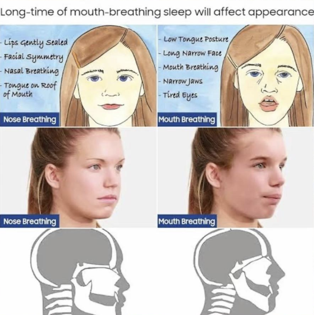 Anak Tidur Mulut Terbuka Setiap Malam, Risiko Mouth Breather