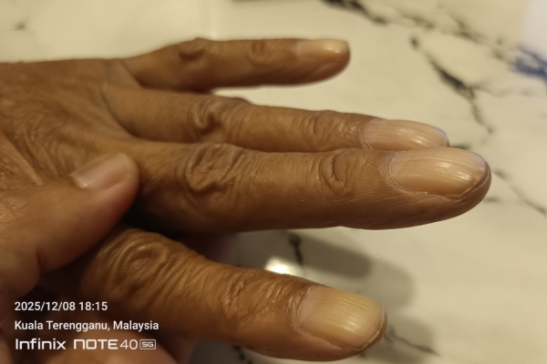 Jenis Kuku Cembung Petanda Bahaya Paru-Paru Kronik